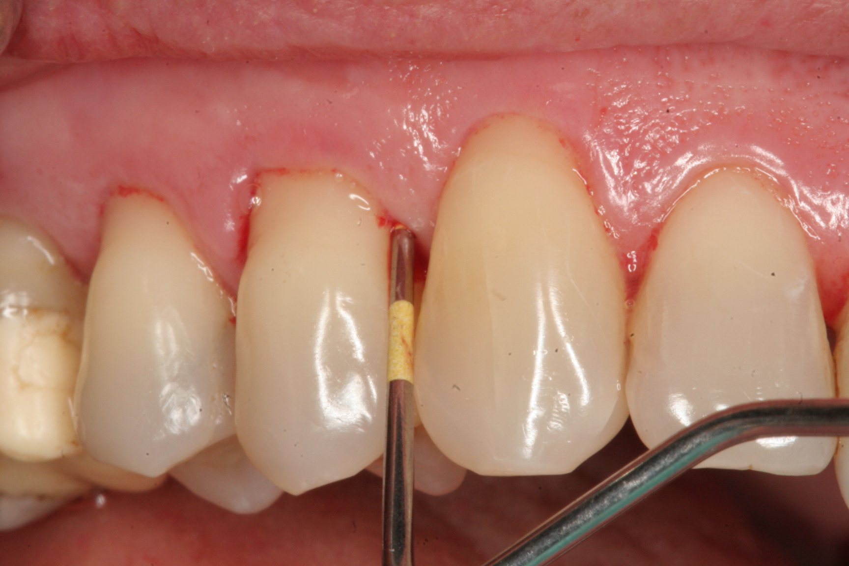 How RPE Works - Perio Peak