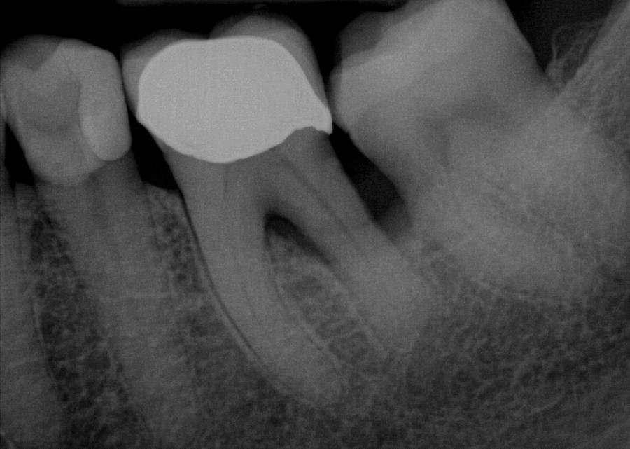 Abscessed Teeth – Perio Peak