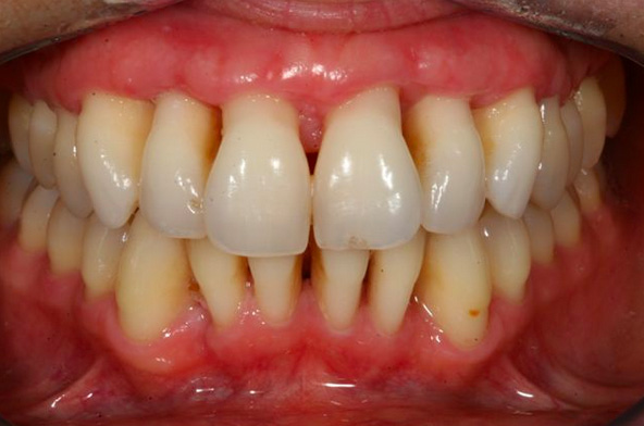 Periodontal Disease Treatment Options - Perio Peak