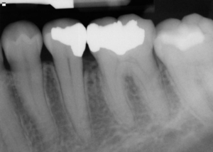 How RPE Works – Perio Peak