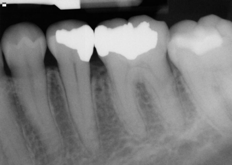 How RPE Works – Perio Peak
