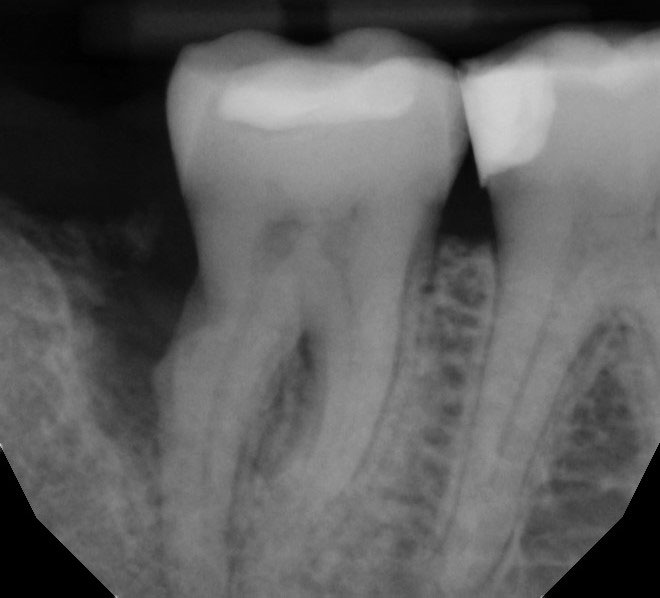 Home - Perio Peak - Regenerative Periodontal Endoscopy