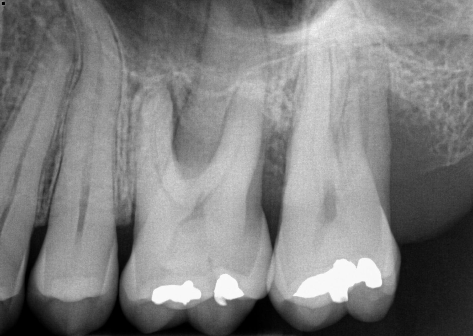 Perio Peak – Regenerative Periodontal Endoscopy