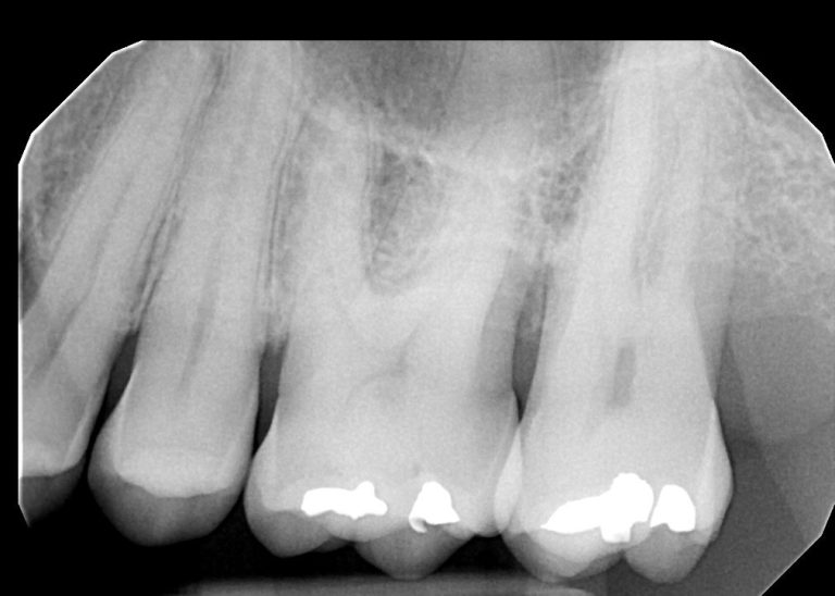 Perio Peak – Regenerative Periodontal Endoscopy